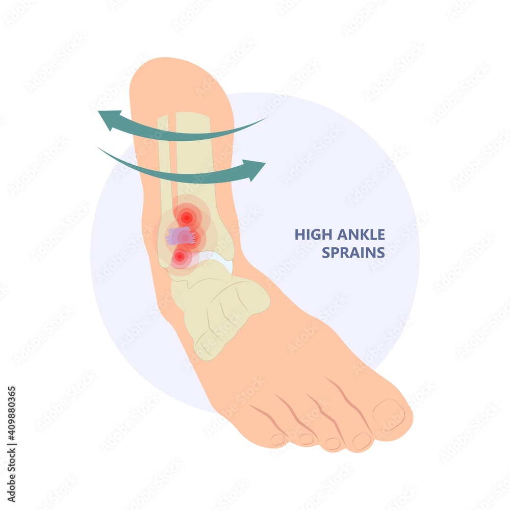 injury Talo Fibular foot treat high low roll twist tear tough bands ...