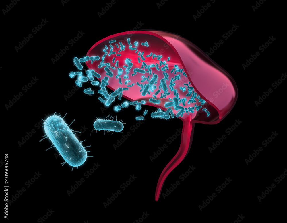 Cross section of the human bladder. Cystitis, an urinary tract ...