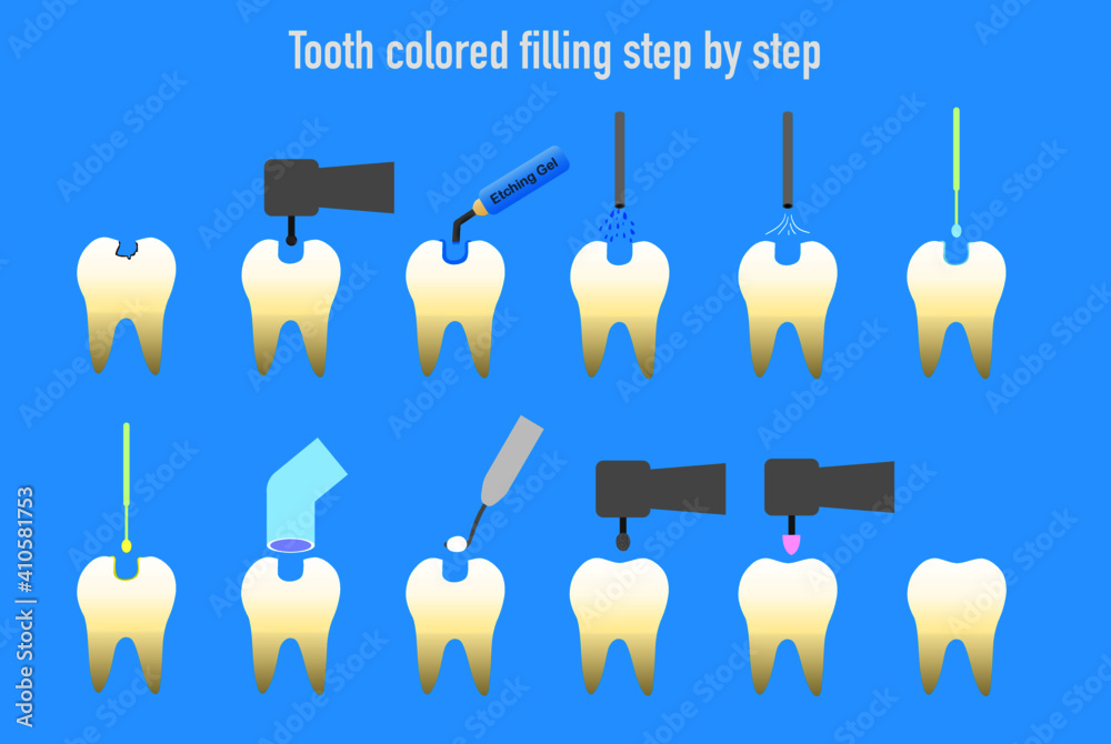 Step by step tooth colored filling, class I Composite. Stock Vector ...