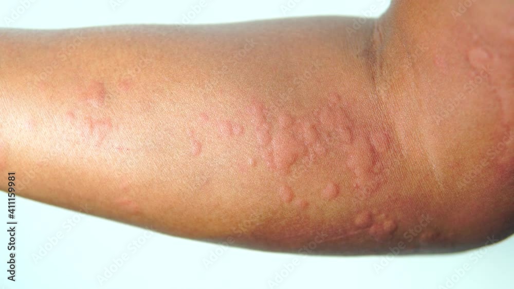 Itchy, allergic reaction, Close up rash with blisters on a man hand ...