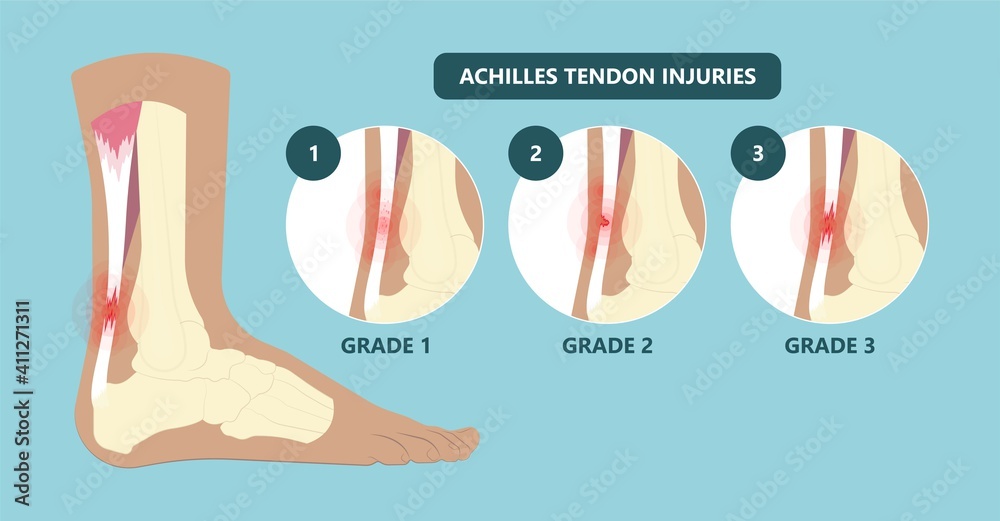 Achilles tendon rupture injury Feet calf test range of motion slight ...