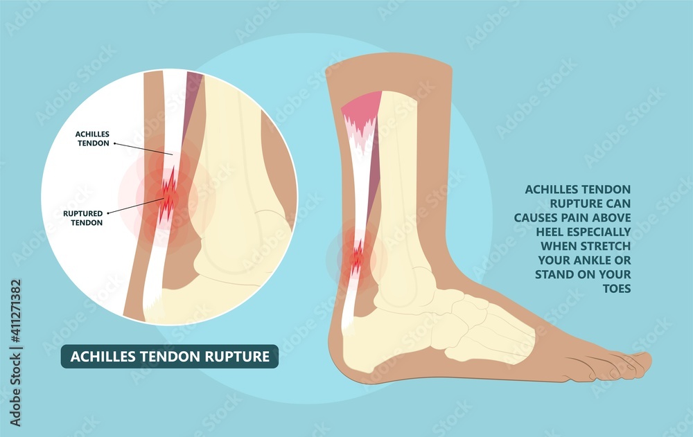 Achilles tendon rupture injury Feet calf test range of motion slight ...