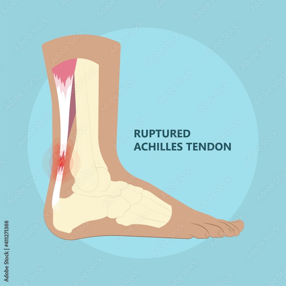 Achilles tendon rupture injury Feet calf test range of motion slight ... Achilles tendon rupture injury Feet calf test range of motion slight ...