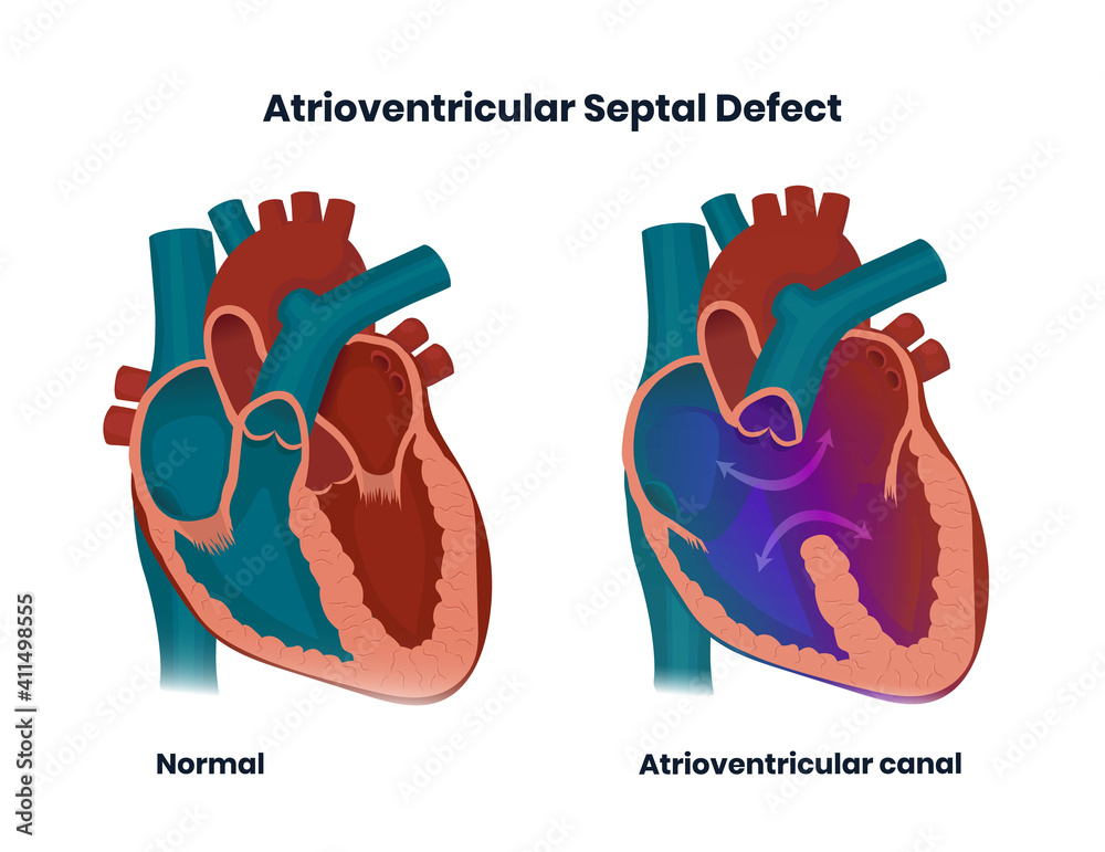Atrioventricular septal defect. Illustration of the congenital heart ...
