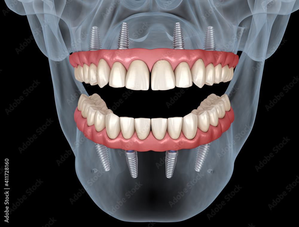 Maxillary and Mandibular prosthesis with gum All on 4 system supported ...