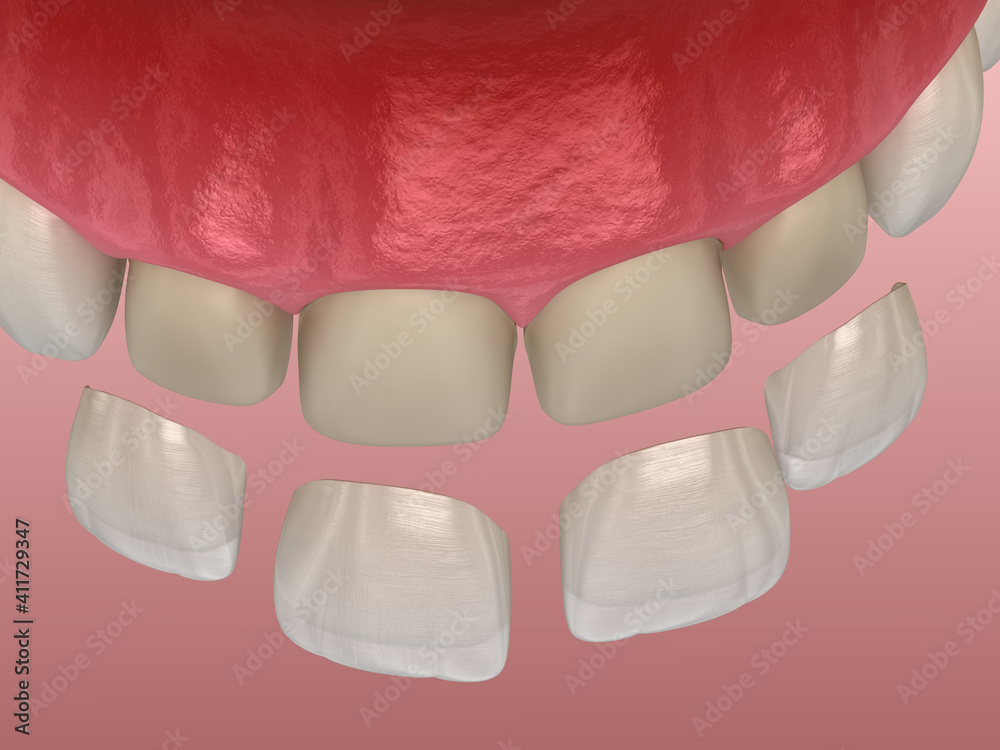 Veneer installation procedure over central incisor and lateral incisor ...