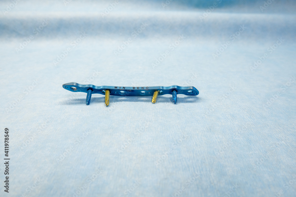explanted titanium plate and 4 titanium screws for the treatment of a ...