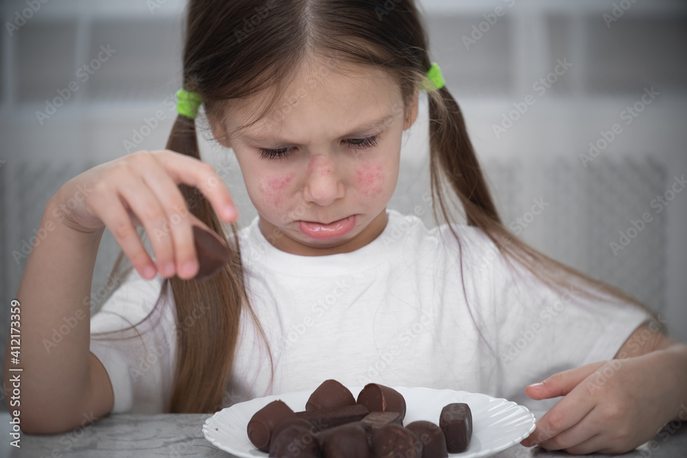 A little girl with an allergic rash on her cheeks sits at a table next ...
