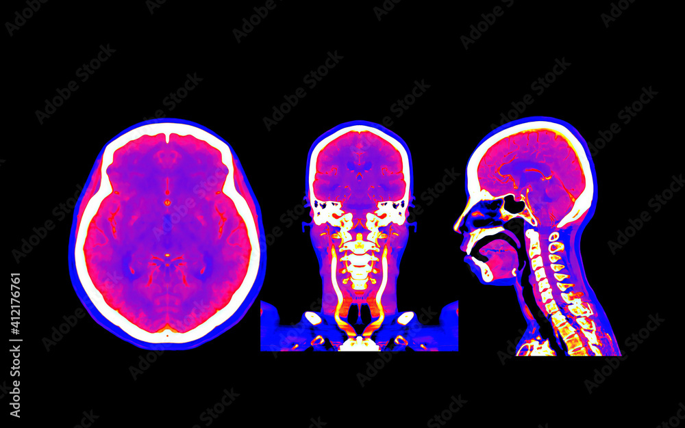 Collection colorful of CT angiography of the brain or CTA brain ...