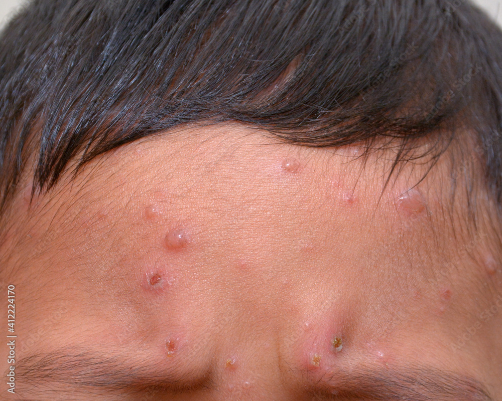 Chicken pox disease on the forehead of South East Asian boy Stock Photo ...