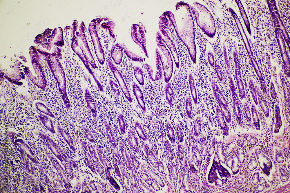human stomach gastric mucosa intestinal metaplasia Stock Photo | Adobe ...