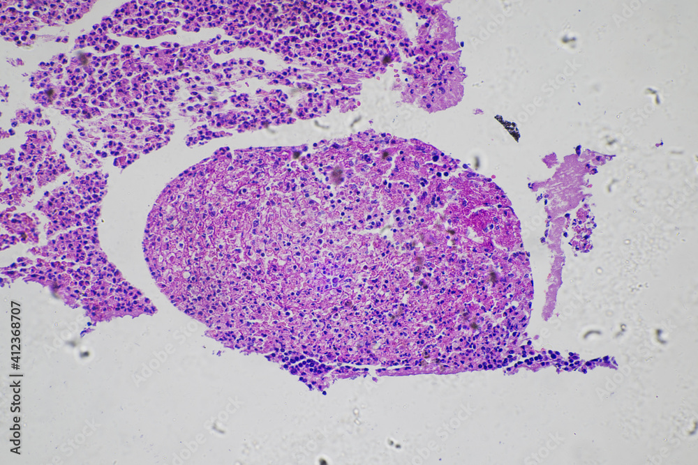 Suppurative inflammation of human appendix Stock Photo | Adobe Stock