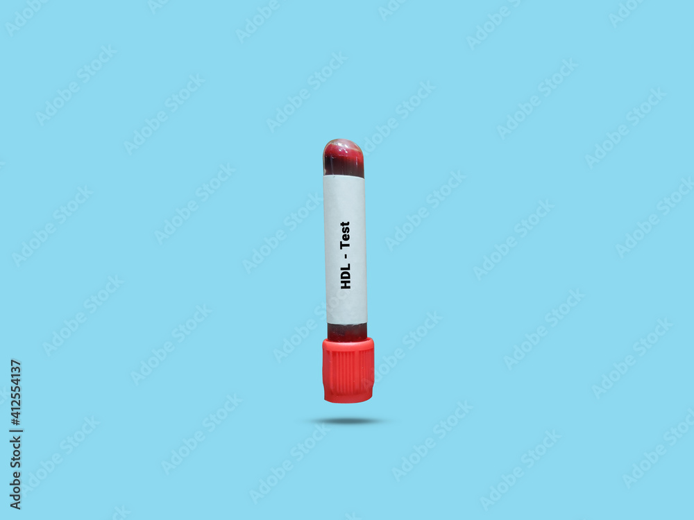 Test Tube with blood sample for HDL (High-density lipoprotein) test ...