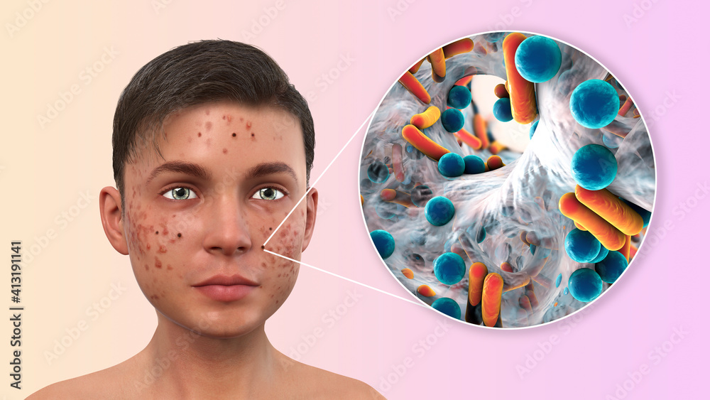 Acne, pimples, and closeup view of bacteria, the causative agents of ...