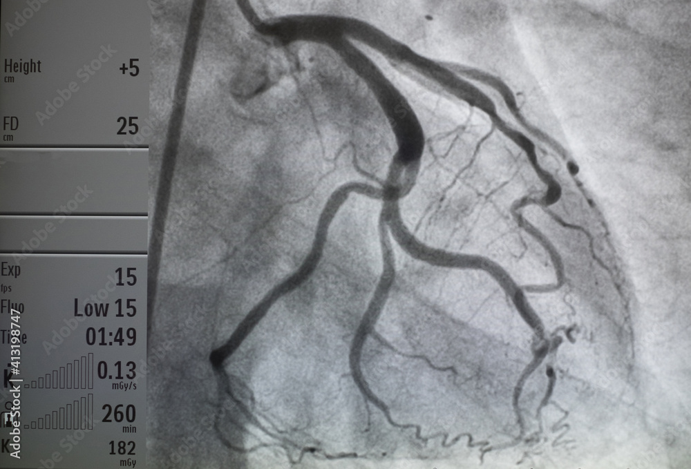 Coronary angiography , medical x-ray for heart disease. Coronary artery ...