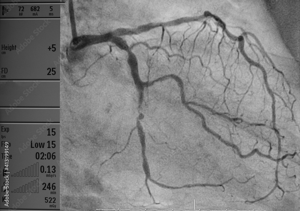 Left Coronary Artery Angiogram