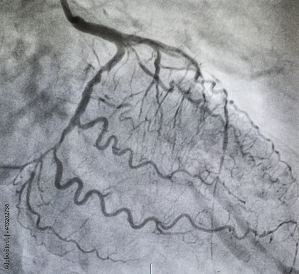 Coronary angiogram , medical x-ray for heart disease. Coronary artery ...