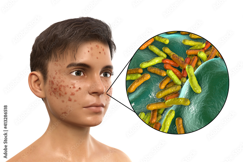 Acne vulgaris and bacteria Cutibacterium acnes Stock Illustration ...