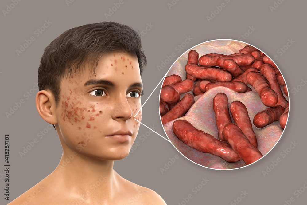 Acne vulgaris and bacteria Cutibacterium acnes Stock Illustration ...