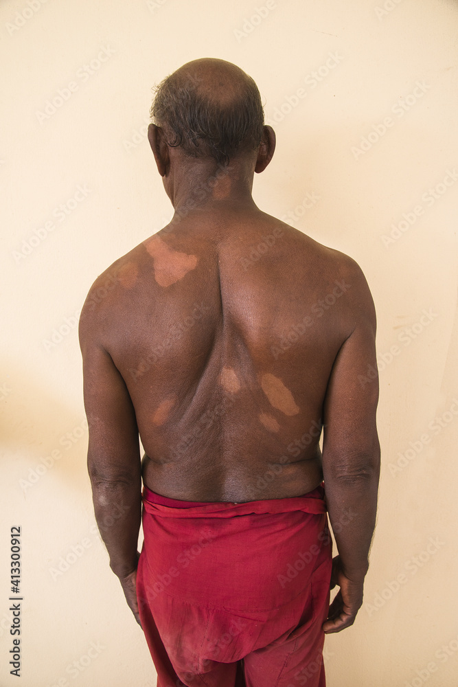 Foto Stock skin of the patient Leprosy , The white band on the back of ...