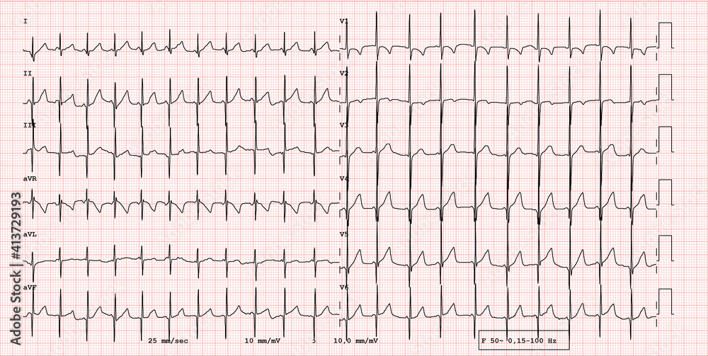 ECG example of a normal 12-lead sinus rhythm of pediatric patient ...