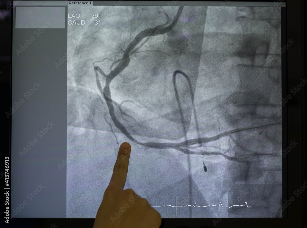 Coronary angiogram , medical x-ray for heart disease. Coronary artery ...