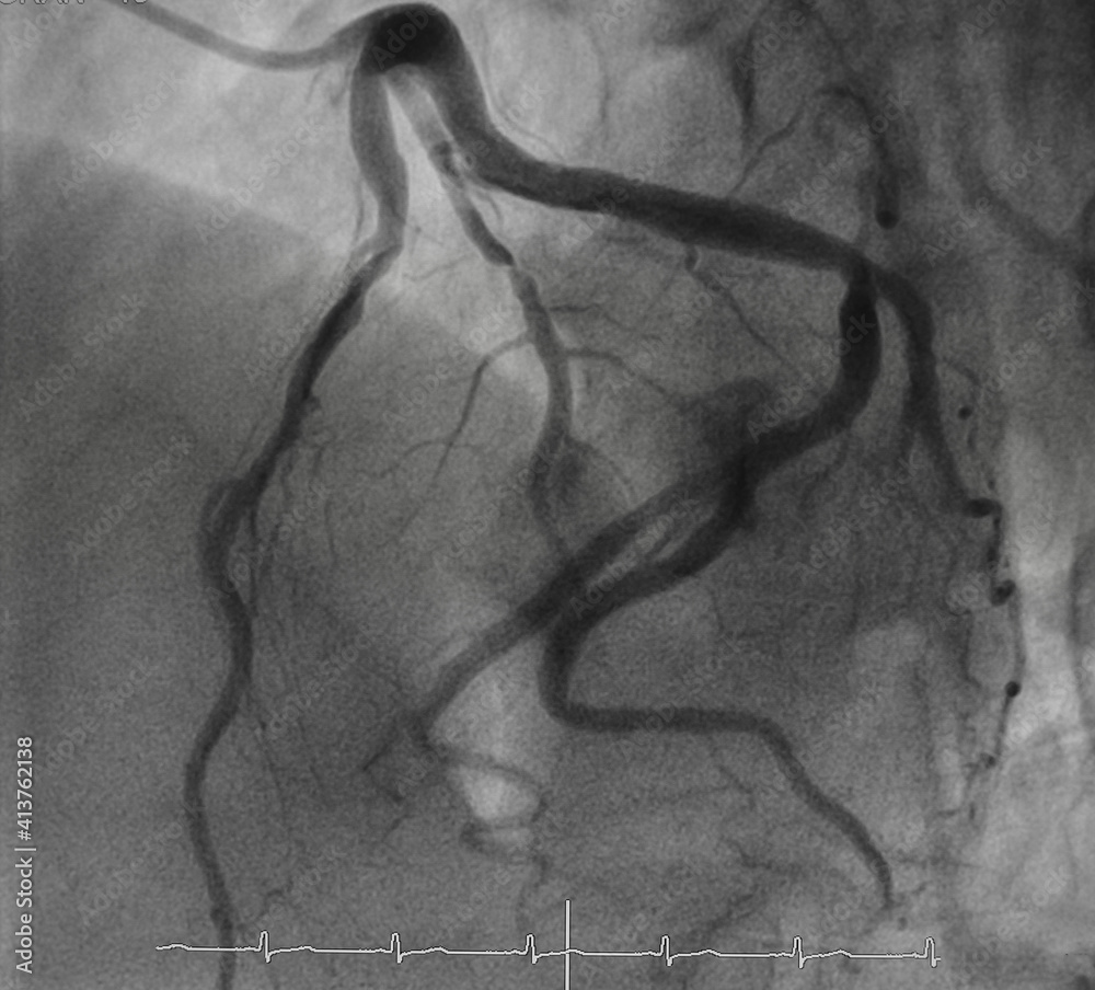 Coronary angiogram , medical x-ray for heart disease. Coronary artery ...