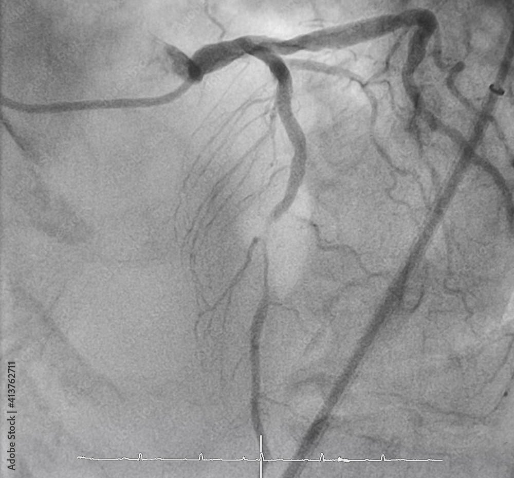 Foto de Coronary angiogram , medical x-ray for heart disease. Coronary ...