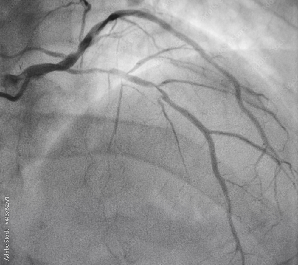 Coronary angiogram , medical x-ray for heart disease. Coronary artery ...