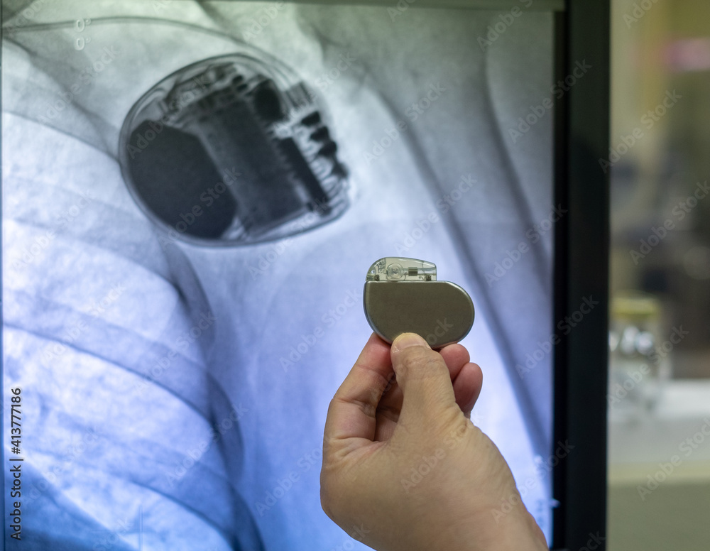 permanent pacemaker implantation device. This image demonstrates ...