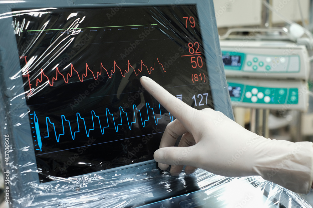 EKG monitor in intra aortic balloon pump machine. Medical equipment ...