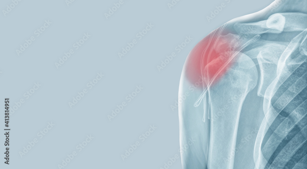 Xray image of shoulder isolated. hanging bicep muscle. Chronic ...