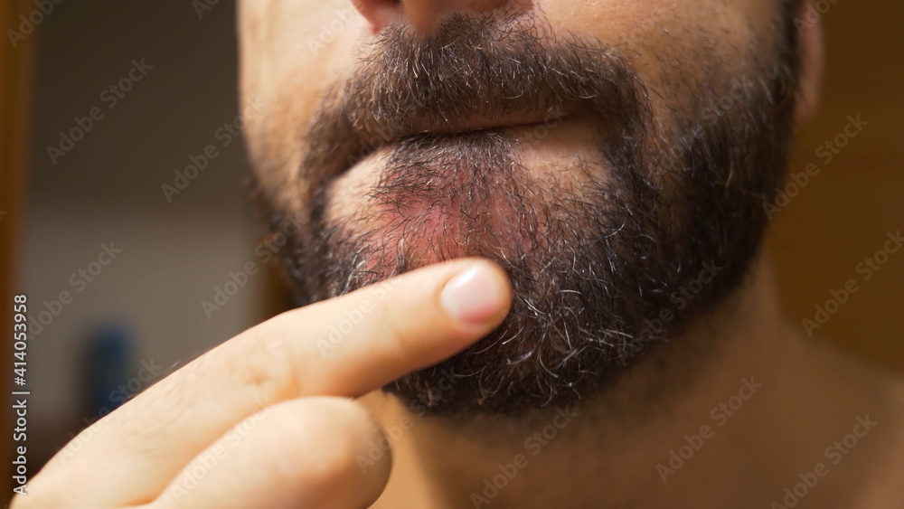 Poster Detail of the man's chin with seborrheic dermatitis in the beard ...