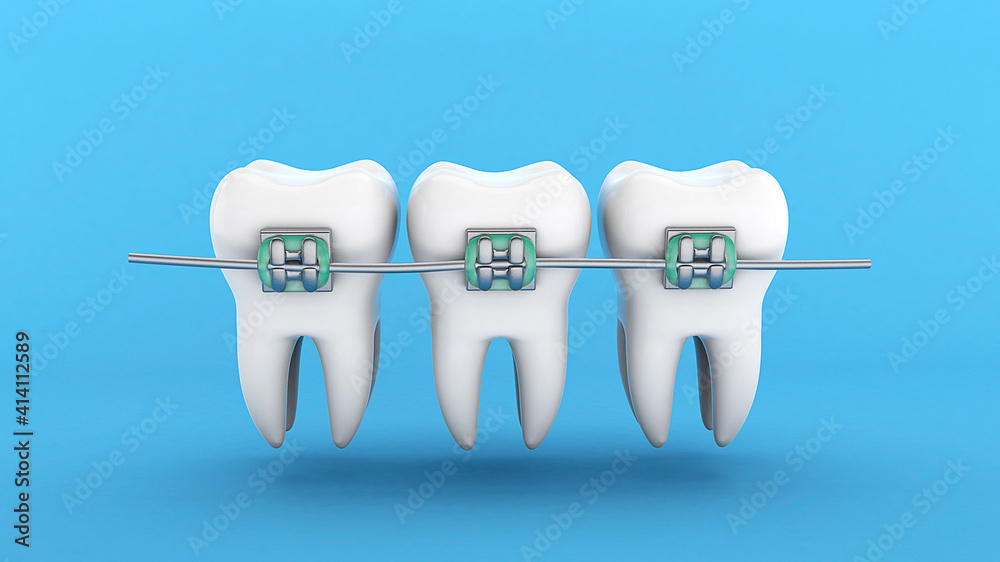 Teal Braces For Teeth