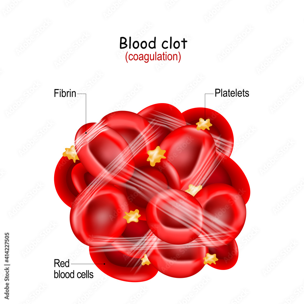 blood clot structure. thrombus Stock Vector | Adobe Stock