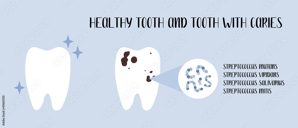 Healthy tooth and tooth with caries. Plaque bacteria: Streptococcus ...