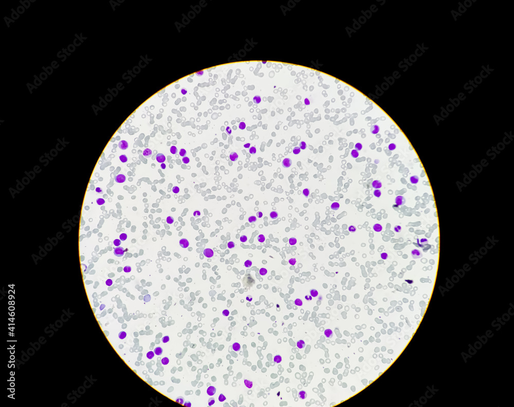 Blood smear under microscopy showing chronic lymphoblastic leukemia ...