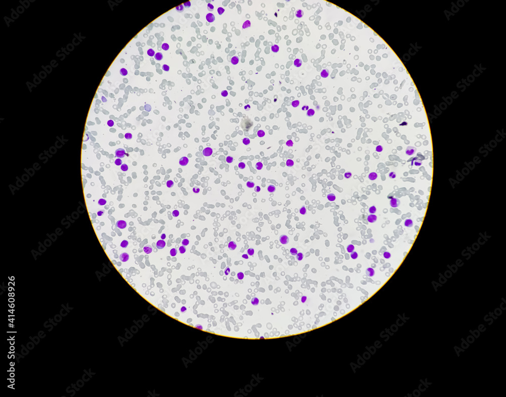 Blood smear under microscopy showing chronic lymphoblastic leukemia ...