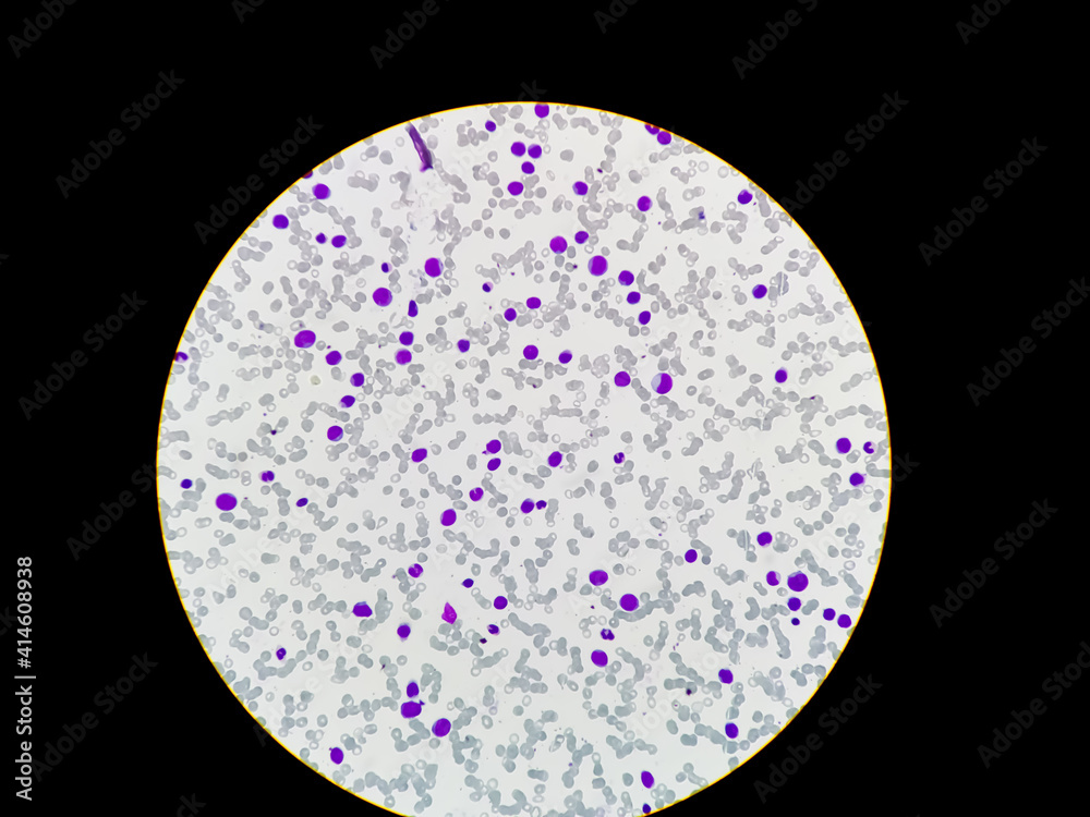 Microscopic images are acquired from blood smears of patients with ...