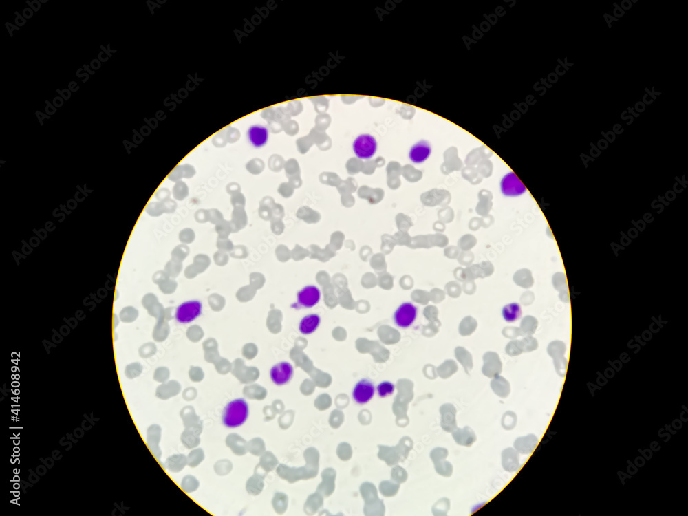 Microscopic images are acquired from blood smears of patients with ...