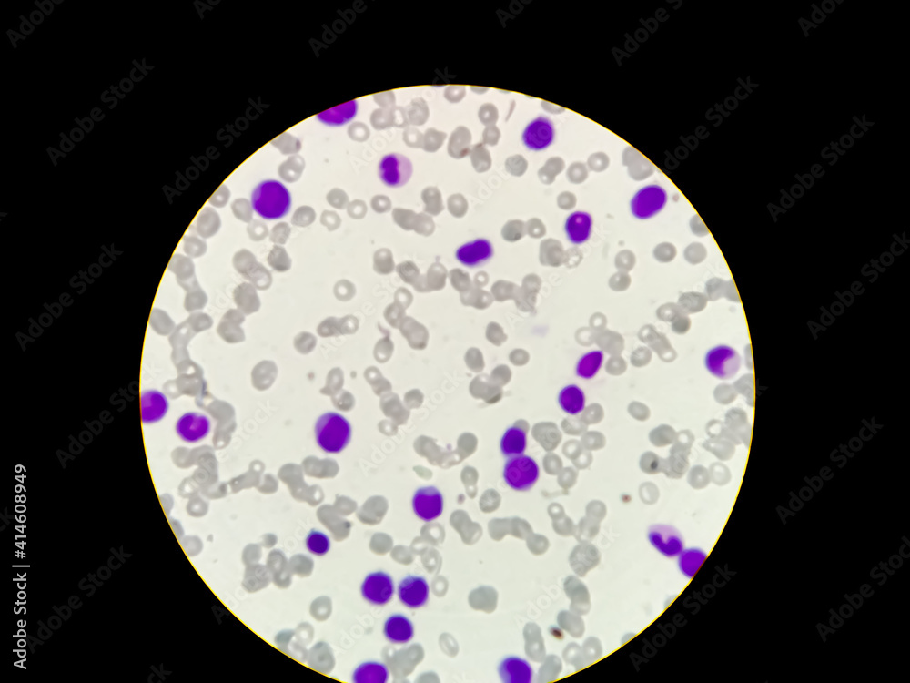 Microscopic images are acquired from blood smears of patients with ...