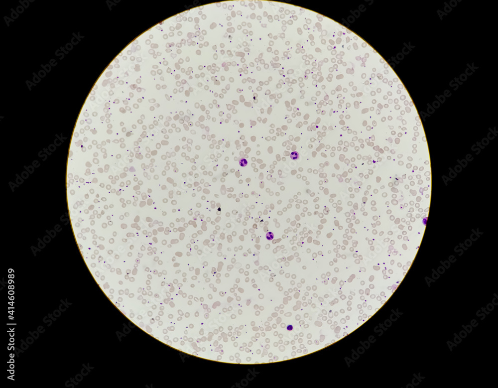 Microscopic blood film show low count of rbc wbc platelets called ...