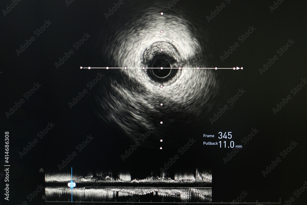 Intravascular ultrasound imaging (IVUS) at cardiac catheterization ...