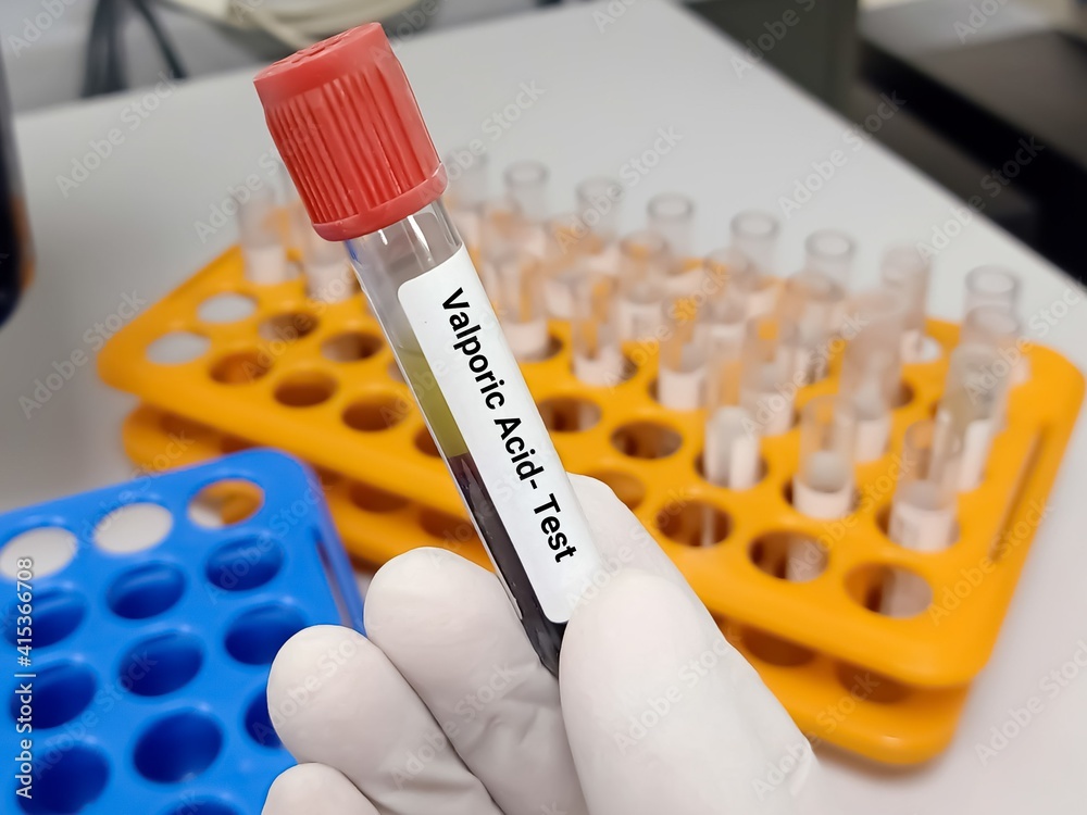 Test Tube with blood sample for Valporic Acid test, a test for maintain ...