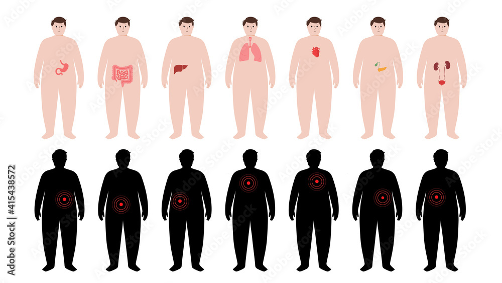 Organs in obese human body Stock Vector | Adobe Stock