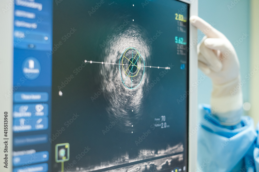 Intravascular ultrasound imaging (IVUS) at cardiac catheterization ...