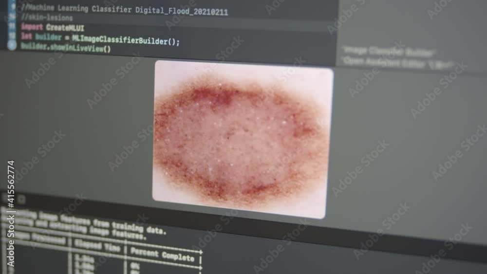 2.24 Real Neural Network Machine Learning Analyzes Skin Lesion Melanoma ...
