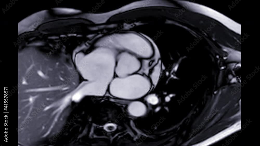 MRI heart or Cardiac MRI ( magnetic resonance imaging ) of heart in ...