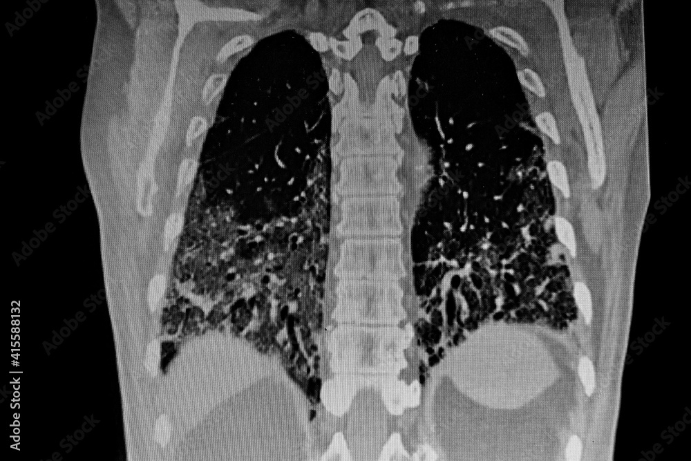 Ground Glass, opacities, crazy-paving, adenovirus pneumonia shows ...