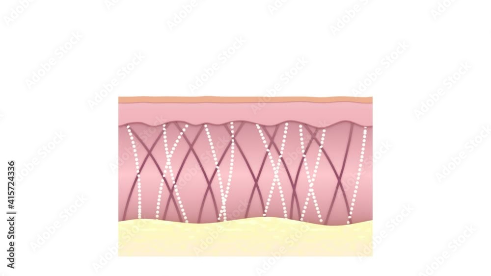 Laser wrinkle treatment. Collagen fibers regeneration. Rejuvenation ...